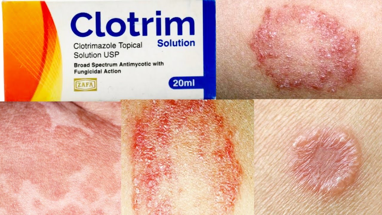 Clotrim Solution uses in Urdu Hindi / Clotrimazole / Fungal Infections ...