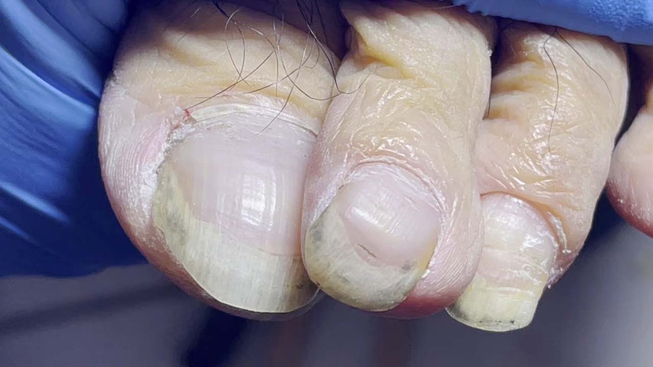 Pedicure Tutorial The Quick Trim Process For Ingrown Toenails Youtube