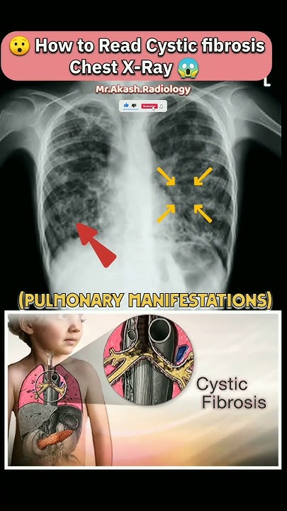 😯how To Read Cystic Fibrosis Chest X Ray😱 Youtubeshorts Cysticfibrosis Xray Chest Disease