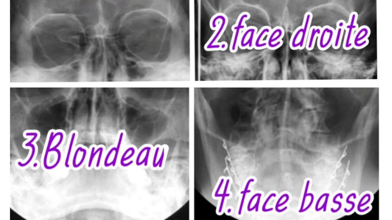 💀 Examen radiologique de crâne 💀☢️ Partie 2 ☢️ Face haute / Face droite ...