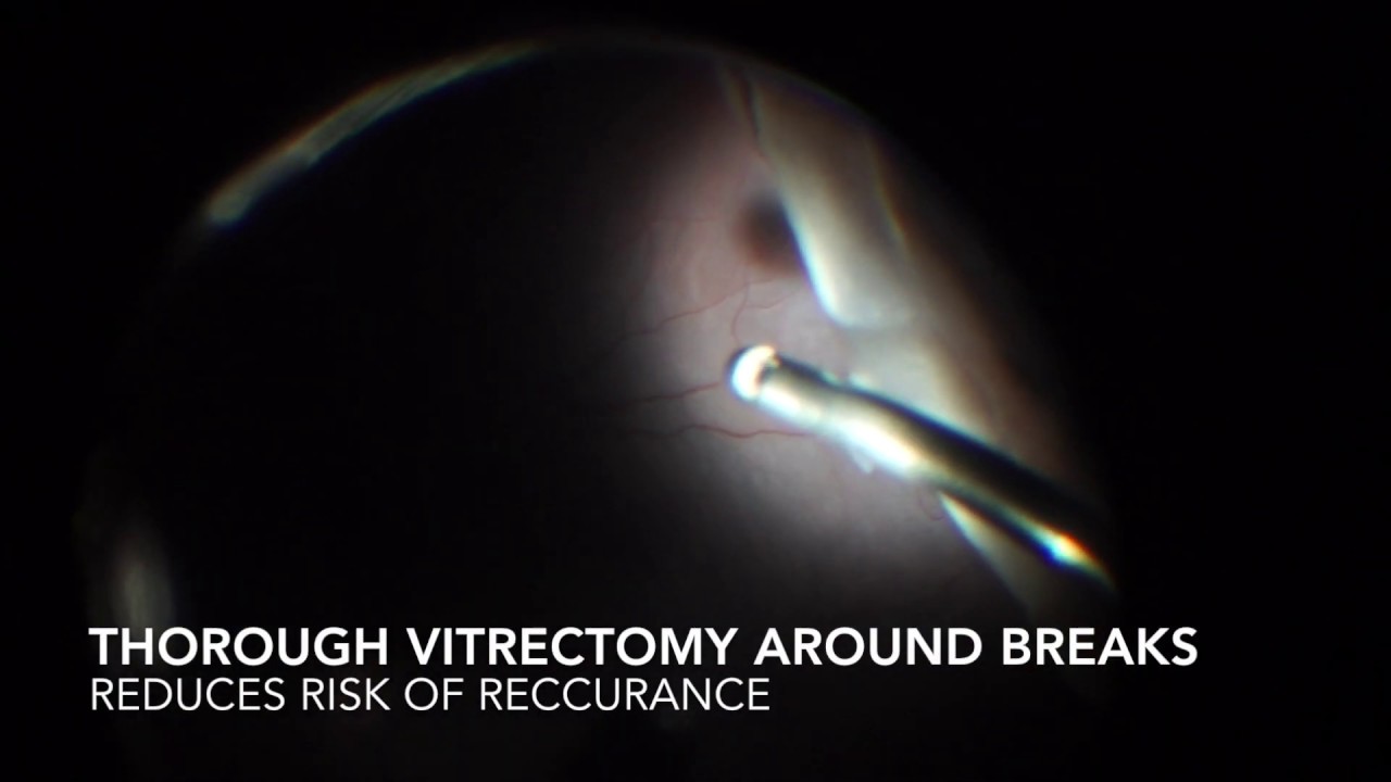 Vitrectomy for Retinal Detachment - Vitreous Base Shaving - Dr ...