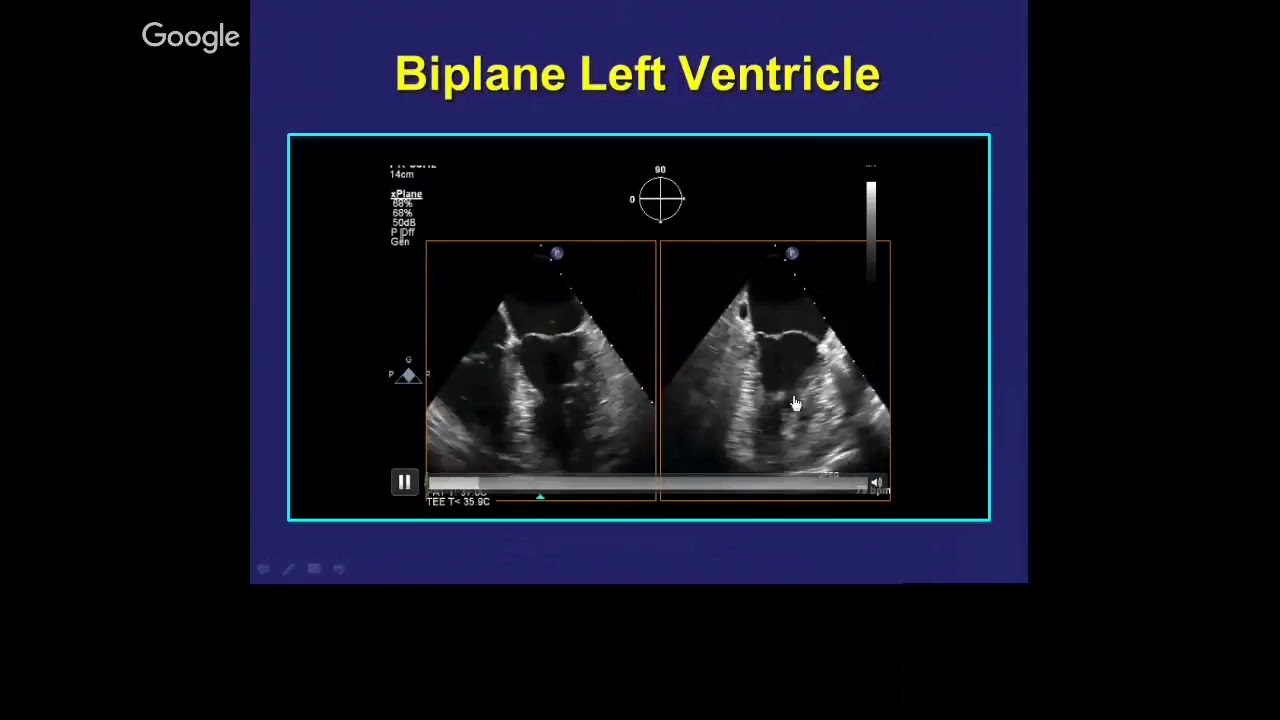 Echocardiography for Surgeons Part IV: The Aortic Valve, Other ...