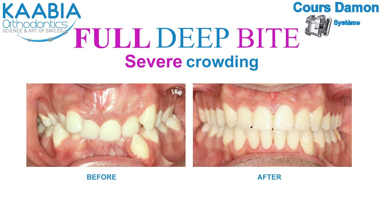 Full deep bite , severe crowding . Supraclusie antérieure et ...