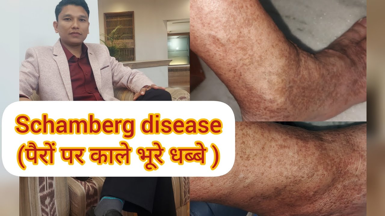 SCHAMBERG DISEASE टांगों में होने वाले धब्बे और निशान #skindiseases # ...