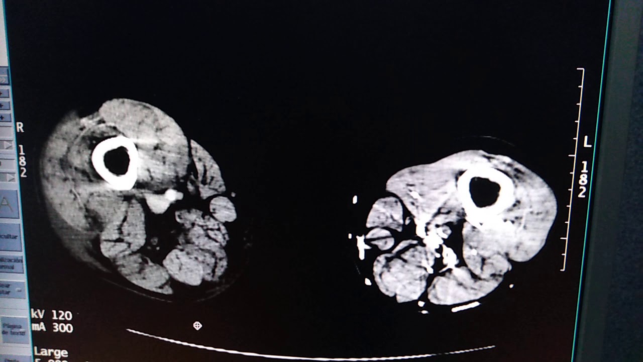 Flegmasia Alba Dolens - YouTube