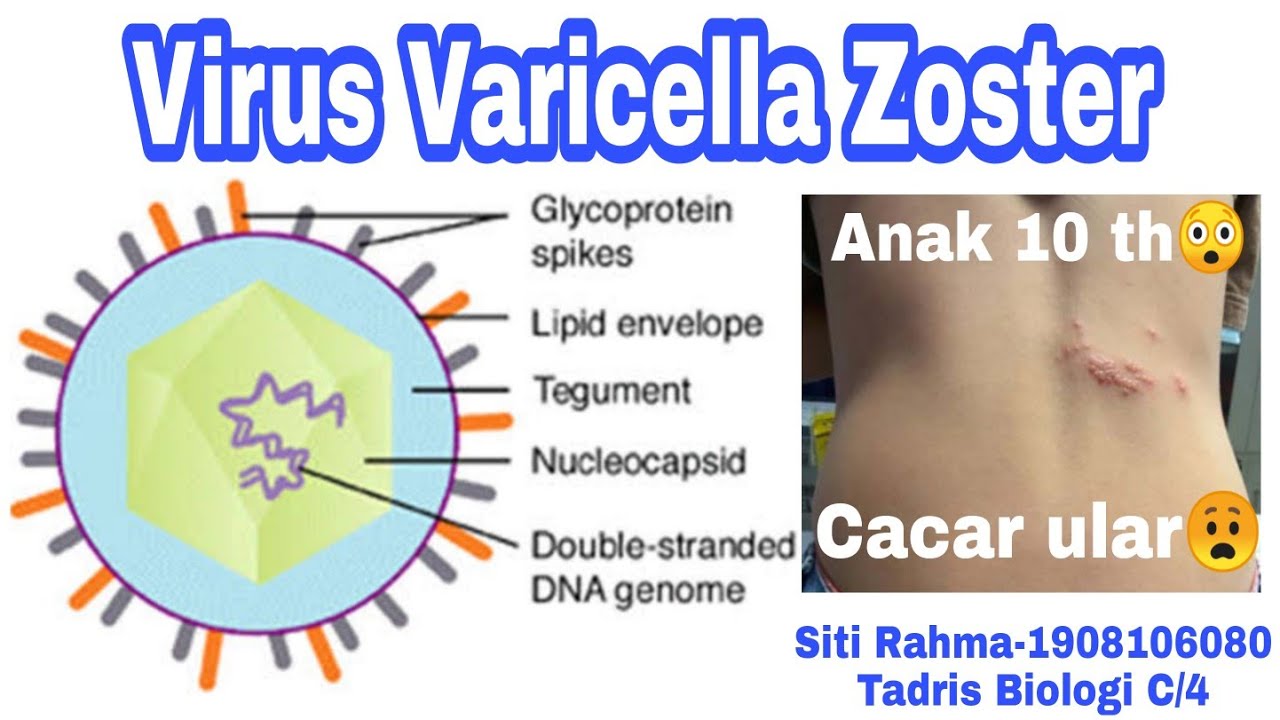 Virus Varicella Zoster Penyebab Cacar Air dan Cacar Ular | UAS ...