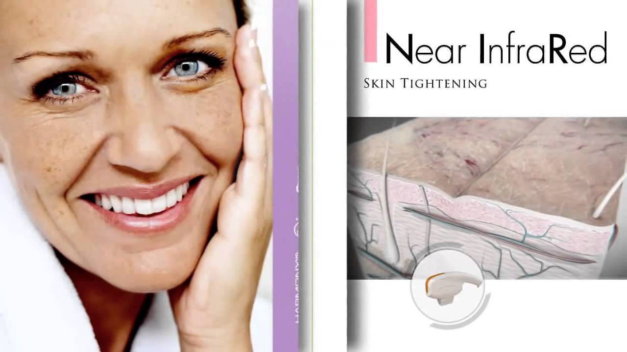 Laser360 iQ by Alma Lasers Ltd - YouTube