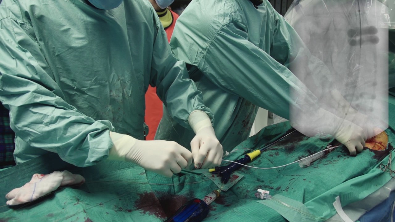 Treatment of AAA with Endologix OVATION Device - YouTube