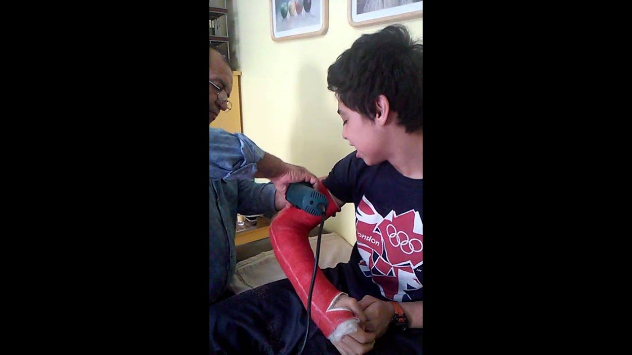 COMO QUITAR UNA FERULA DE FIBRA DE VIDRIO - YouTube