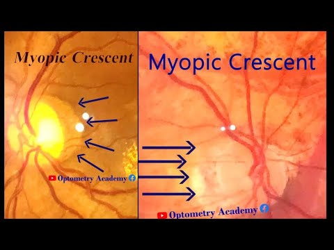 Myopic Crescent Fundus video - YouTube