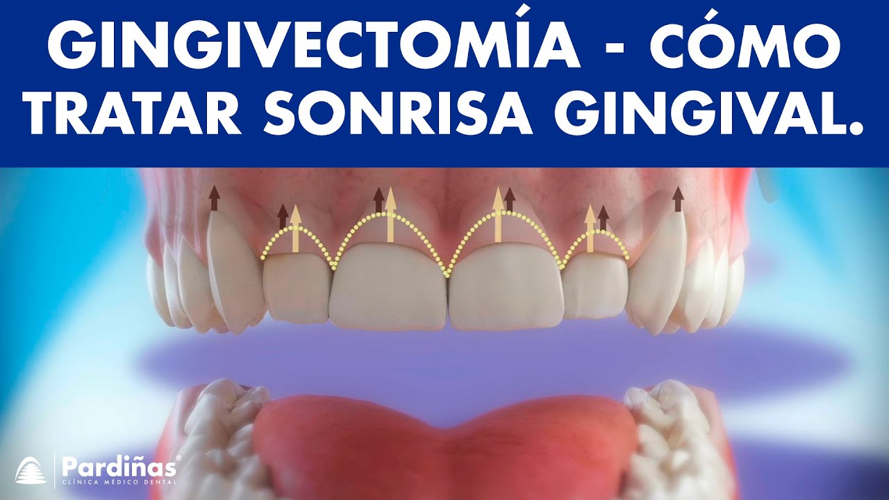 Gingivectomía - Tratamiento de la sonrisa gingival o exceso de encía ...
