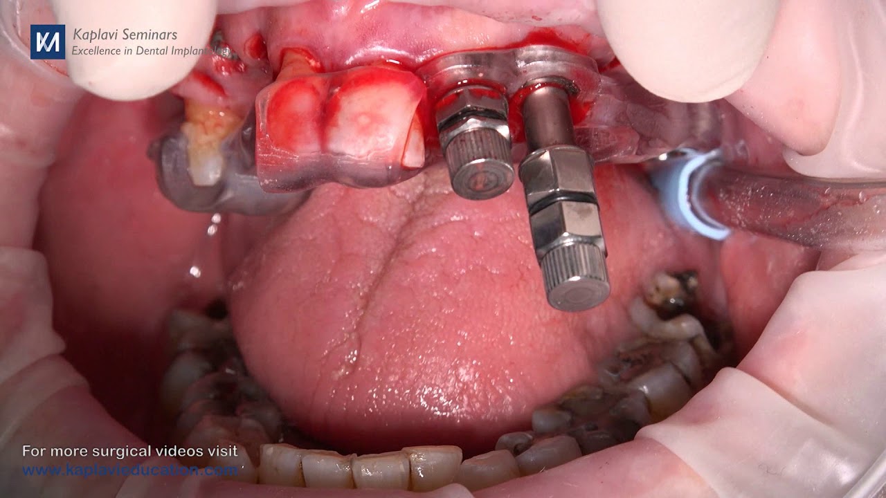 Full arch maxillary guided surgery with sequential guides -All on 7 ...