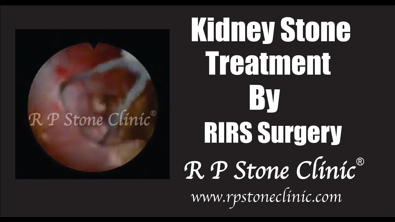 Kidney stone treatment by RIRS Surgery | Kidney Stone Treatment - YouTube