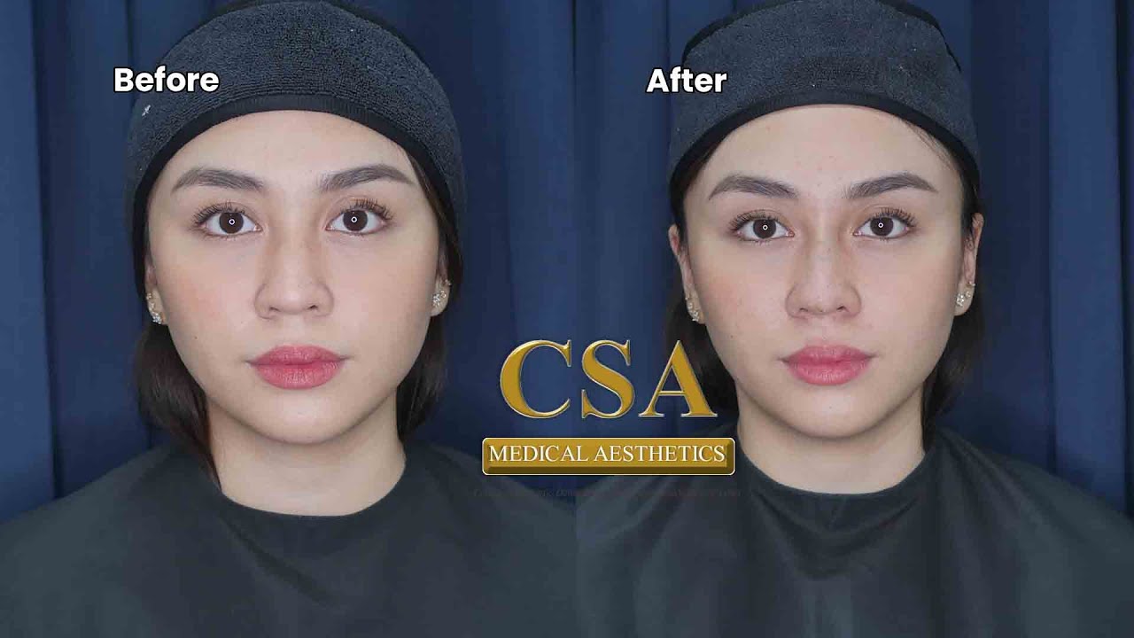 NONSURGICAL NOSELIFT USING 3 WAY TECHNIQUE - YouTube