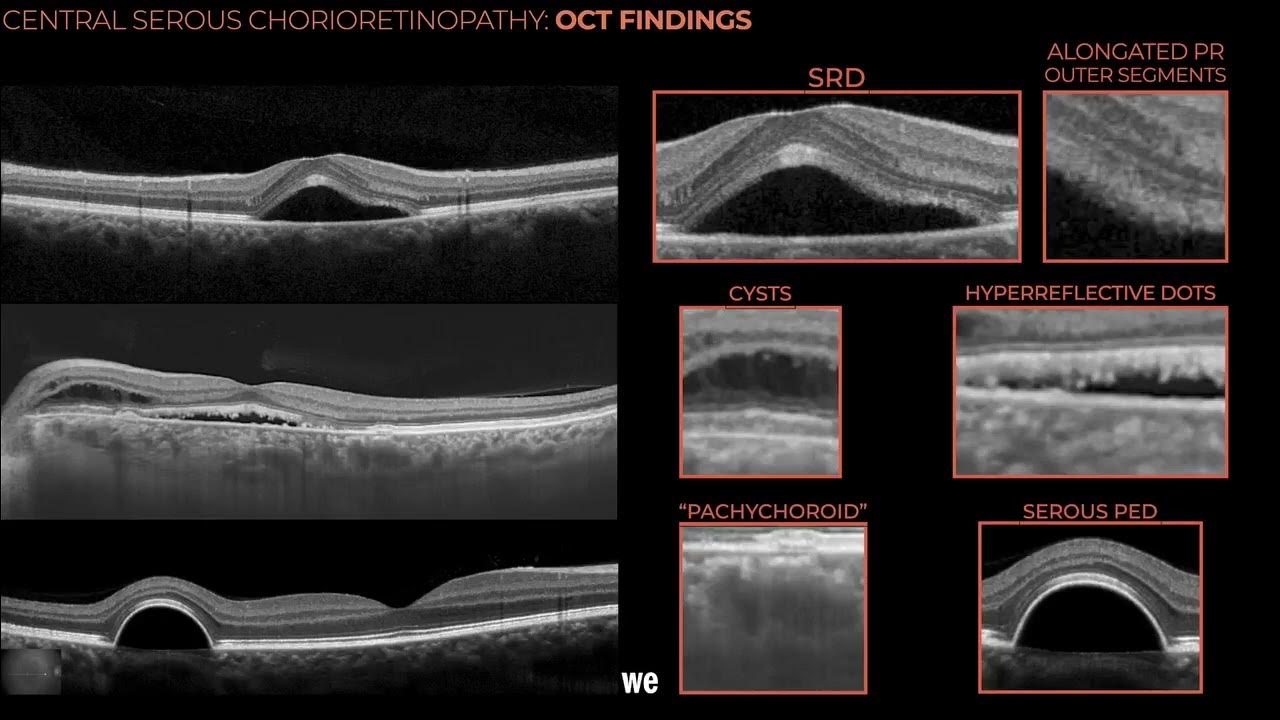 Mais um trecho do curso "OCT - do básico ao laudo" Você realmente domina o exame de OCT ...