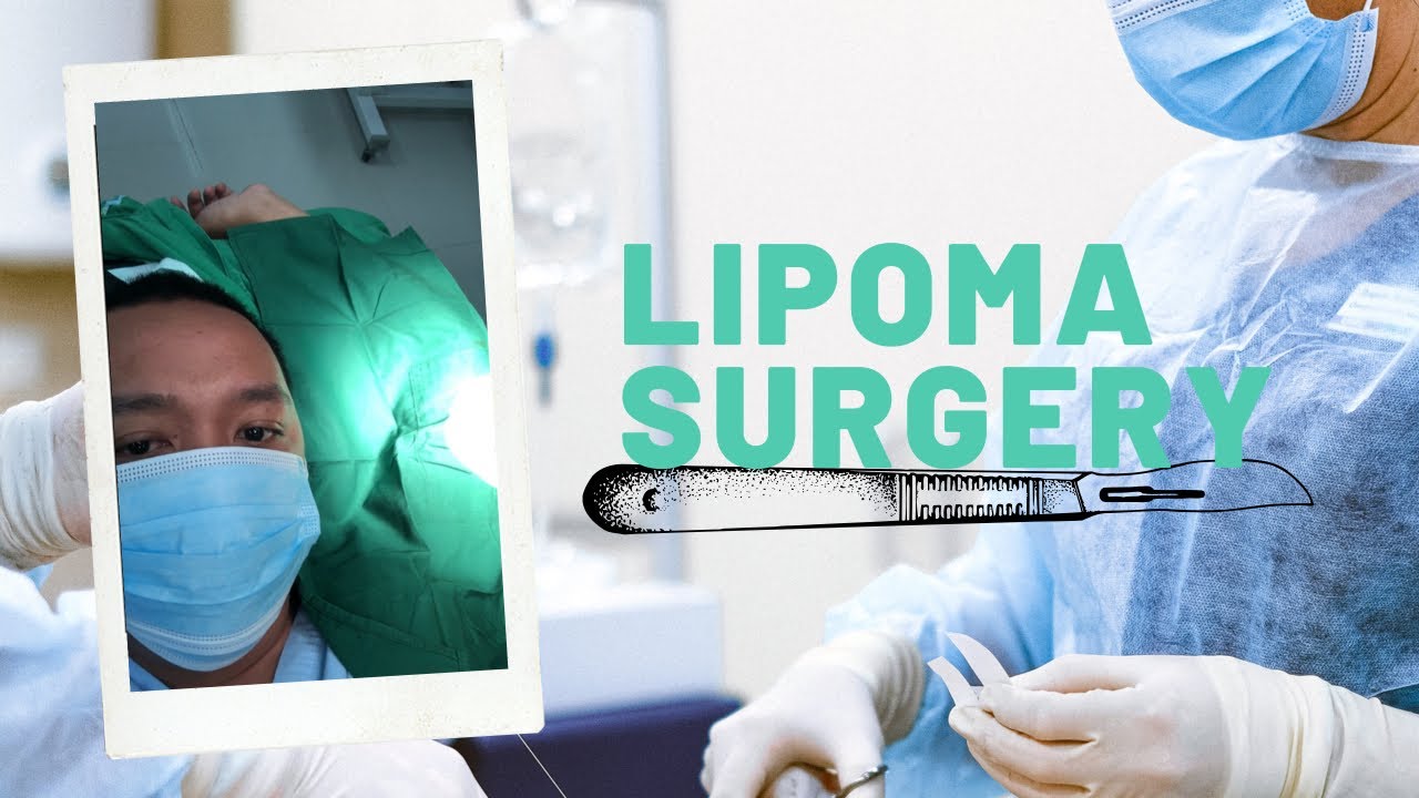 Benjolan di lengan, harus kita apakan ??!! (Story of Lipoma Surgery ...