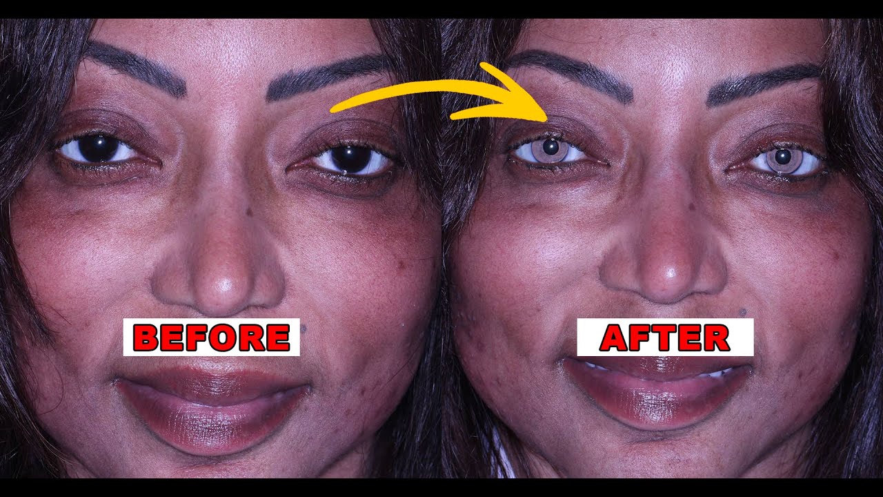 What's REALLY Behind the Rise in Eye Color Changing Surgeries? - YouTube