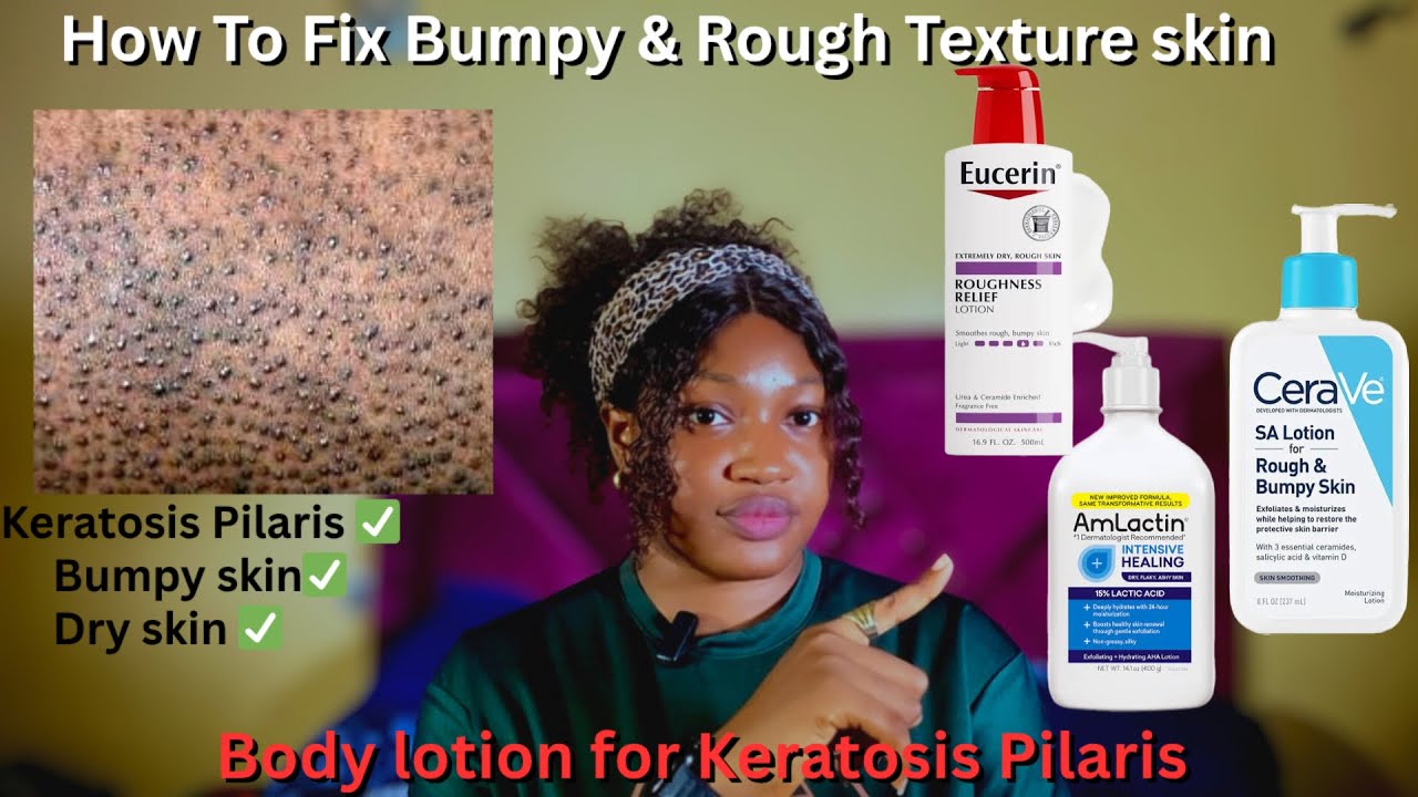 Keratosis Pilaris Treatment : How to Get Rid of Chicken Skin Fast ...