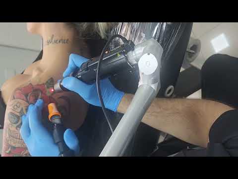 Remoção da tatuagem da Letícia Alonso aqui na Hell Tattoo