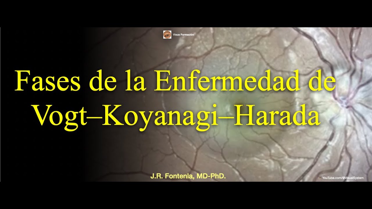 Fases de la Enfermedad de Vogt–Koyanagi–Harada. - YouTube