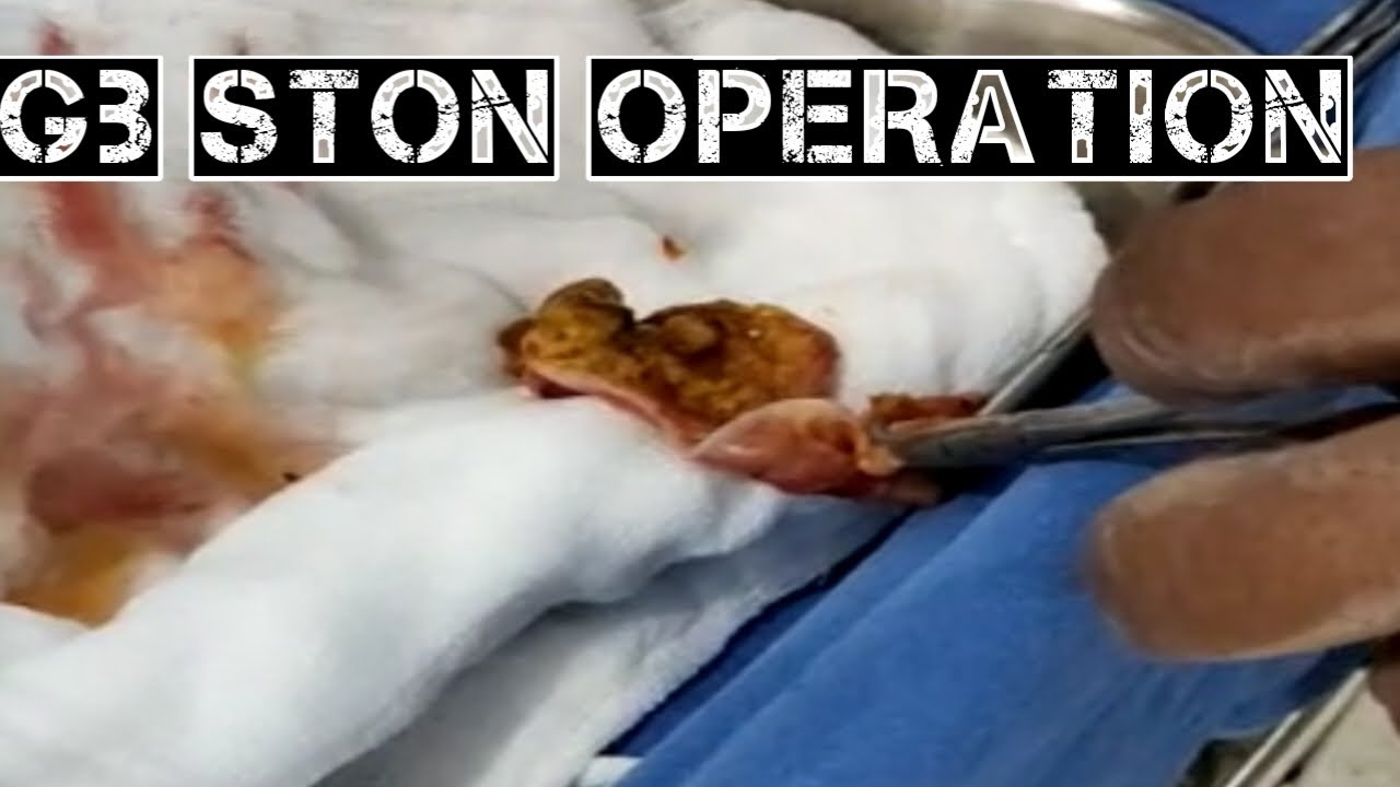 पित की थैली की ऑपरेशन #gb stone operation #vlog #gb stone kaise remove hota jai - YouTube