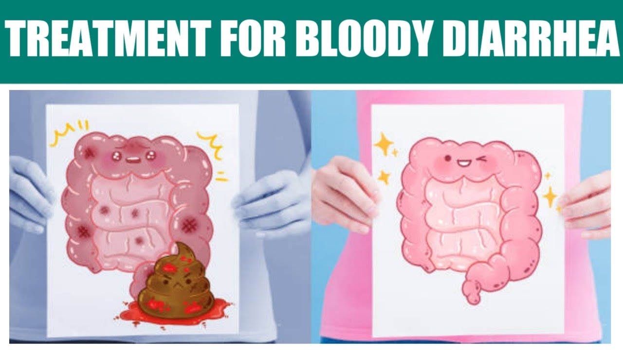 How to Treat Bloody Diarrhea? Causes & Remedies - YouTube
