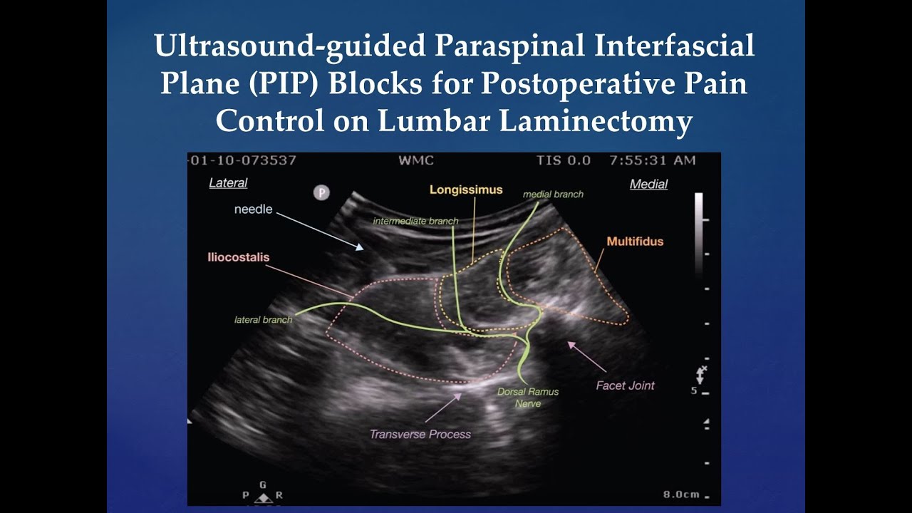 Ultrasound-guided Paraspinal Interfascial Plane (PIP) Blocks for Lumbar ...