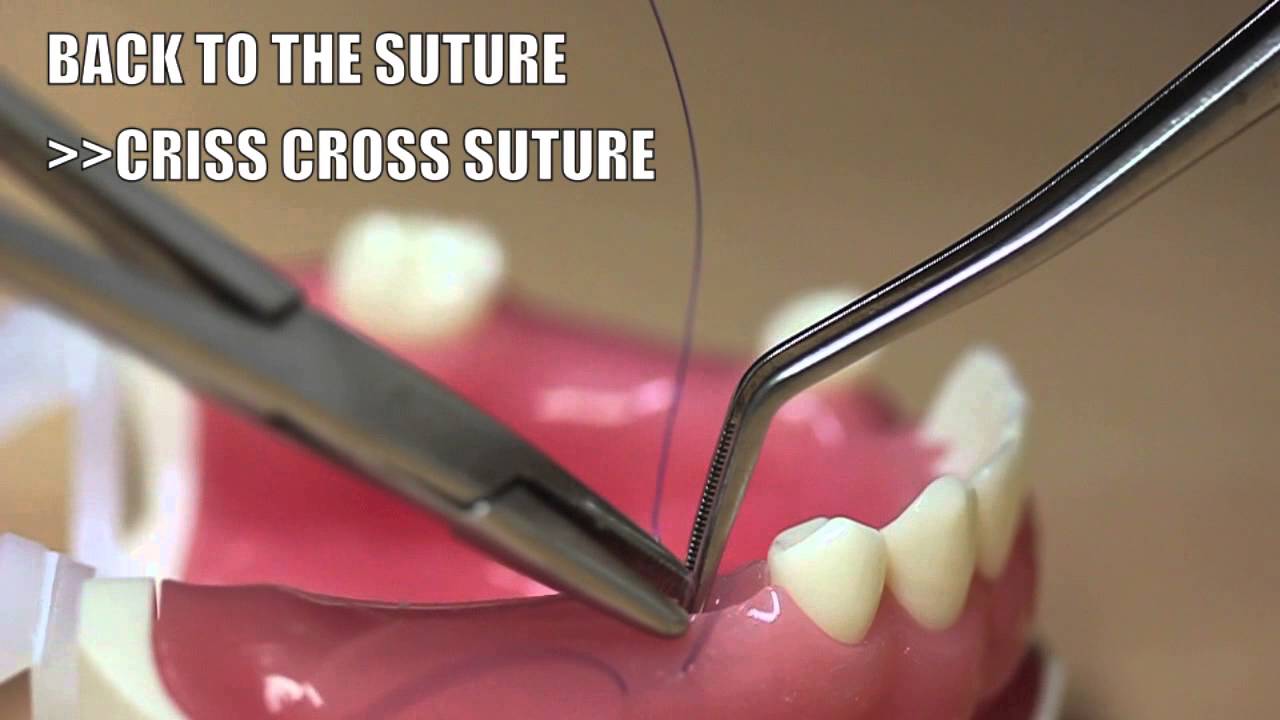 Back to the suture - 4 Criss Cross suture - YouTube