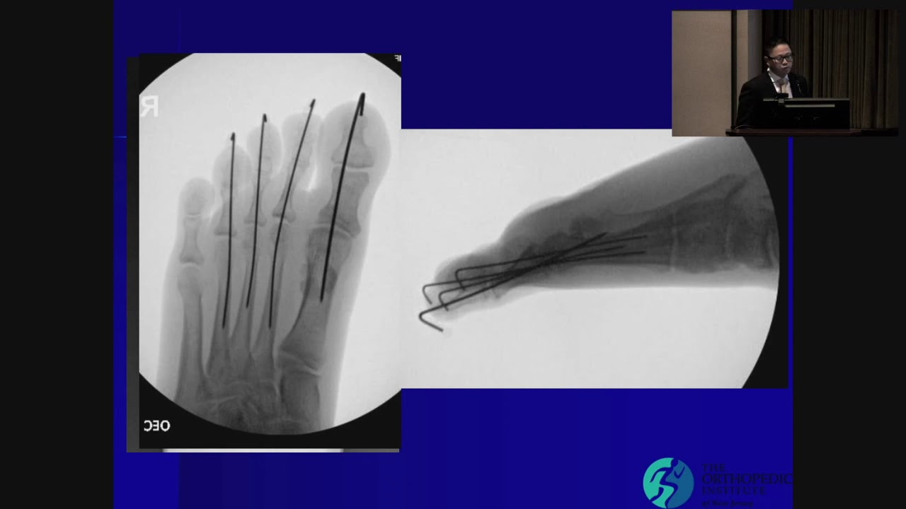 Common Foot Fractures - Kevin White, DO - YouTube