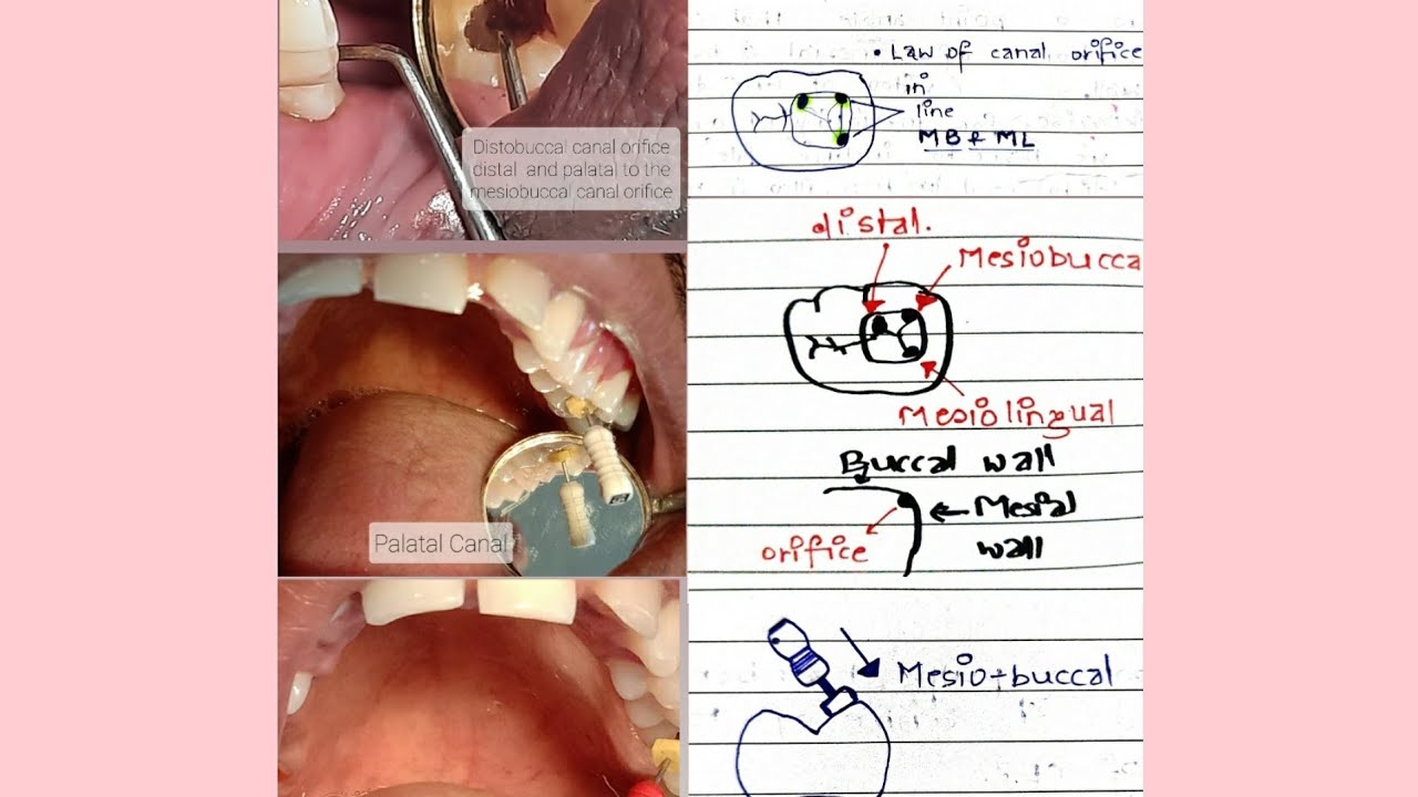 Locating CANAL ORIFICES was never this EASY!! Mandibular and Maxillary ...