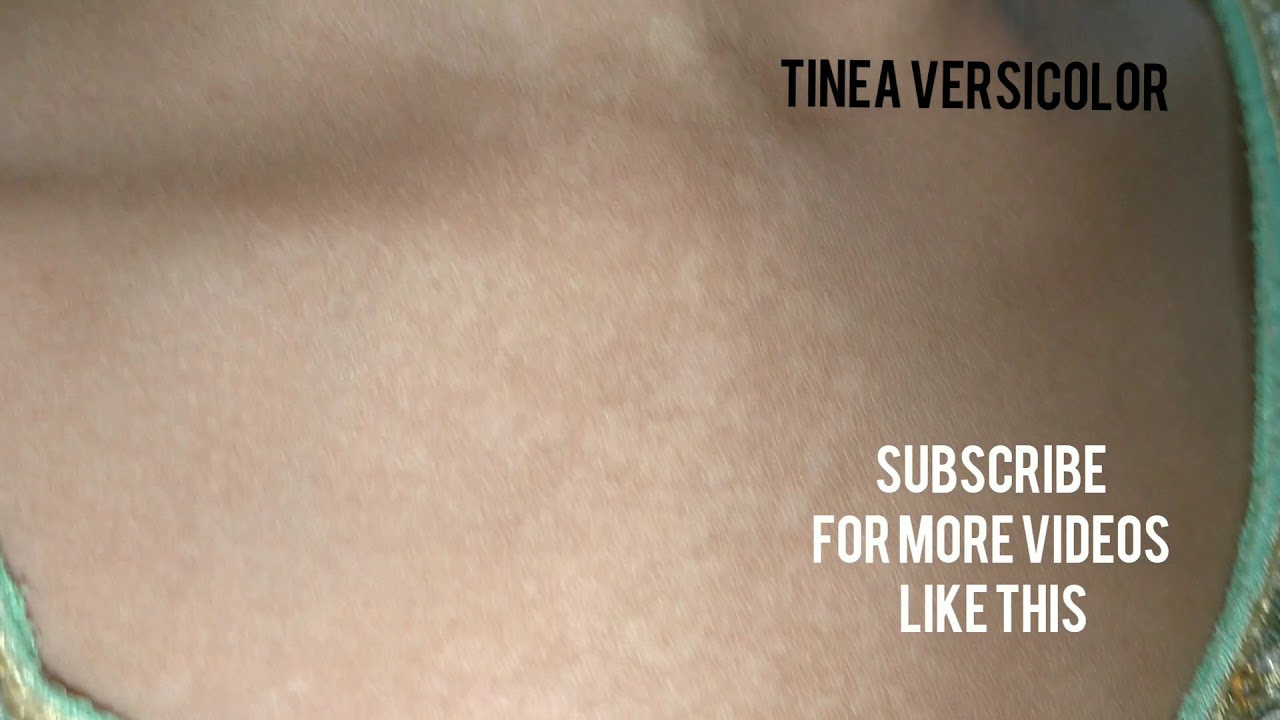 Tinea versicolor on chest A contagious fungal infection on chest - YouTube