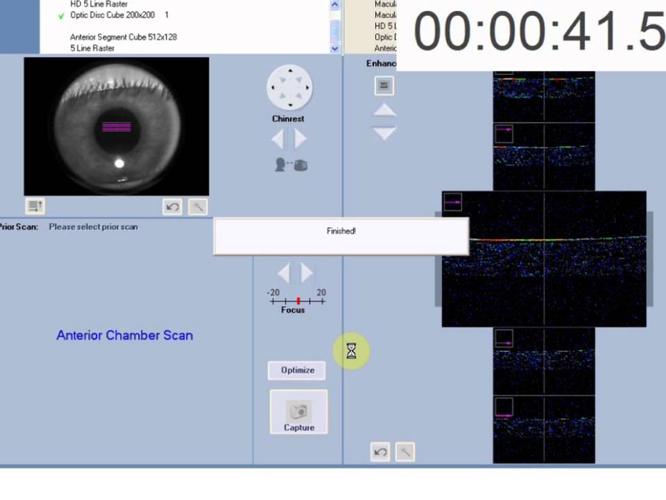 Optical Coherence Tomography - Glaucoma Relevant Examinations - YouTube