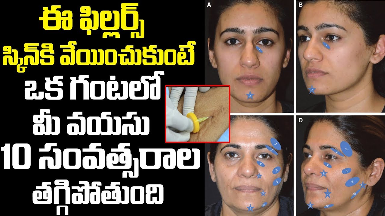 Cosmetic Facial Fillers and Injections|Permanent Filler injections for ...