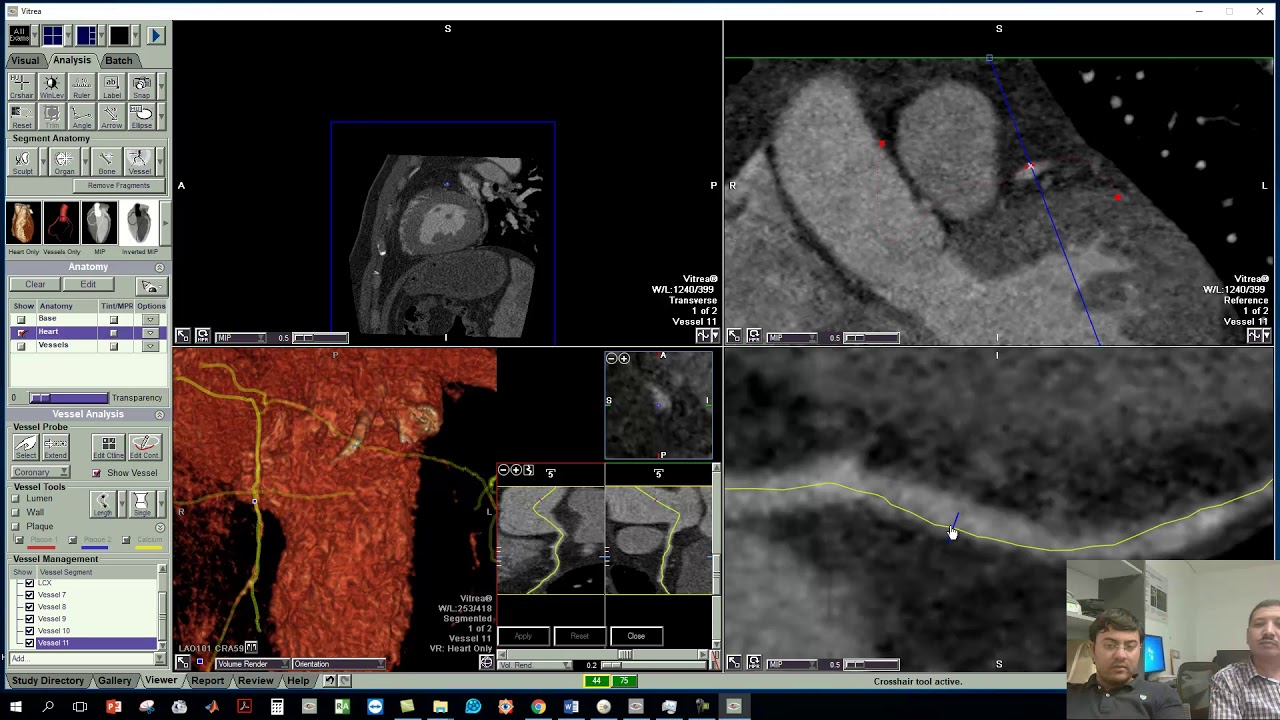 Coronary post processing upon Vitrea 6 ,,,, video 1 - YouTube