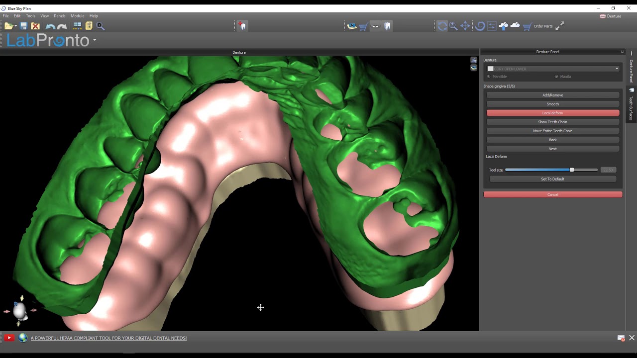 Hacking the Blue Sky Bio Digital Denture Software to Make Nightguards ...