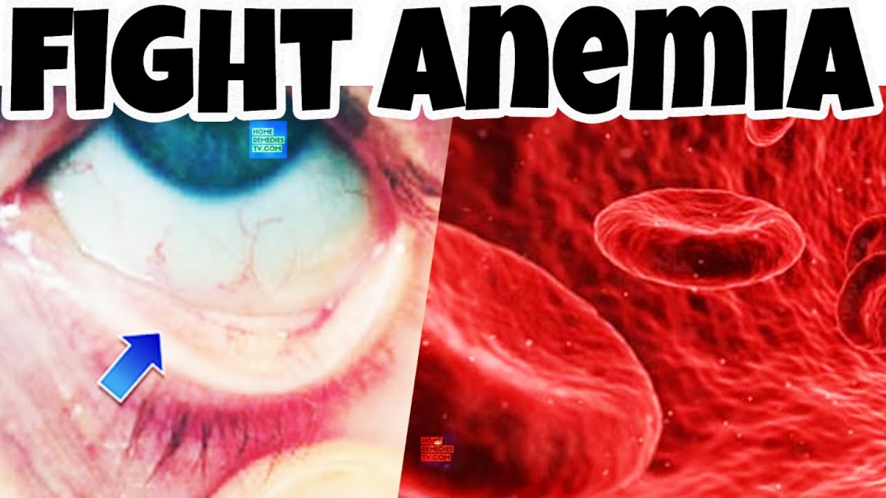 What FOODS are [GOOD] to FIGHT ANEMIA? ADD These HEALTHY FOODS to your ...