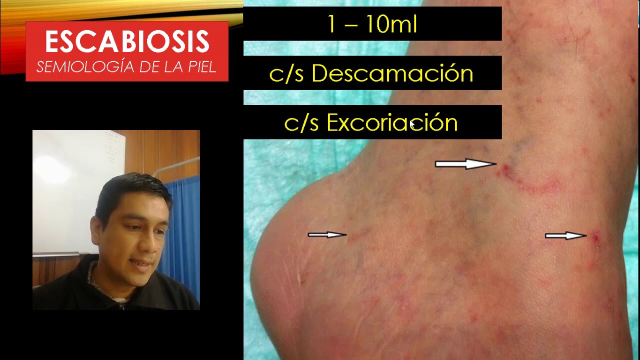 01/08/2020 SARNA, RASCA RASCA O ESCABIOSIS - YouTube