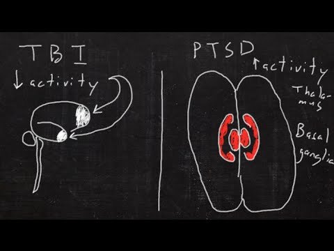 Brain imaging can distinguish PTSD from TBI - Discover Magazine Top 100 ...