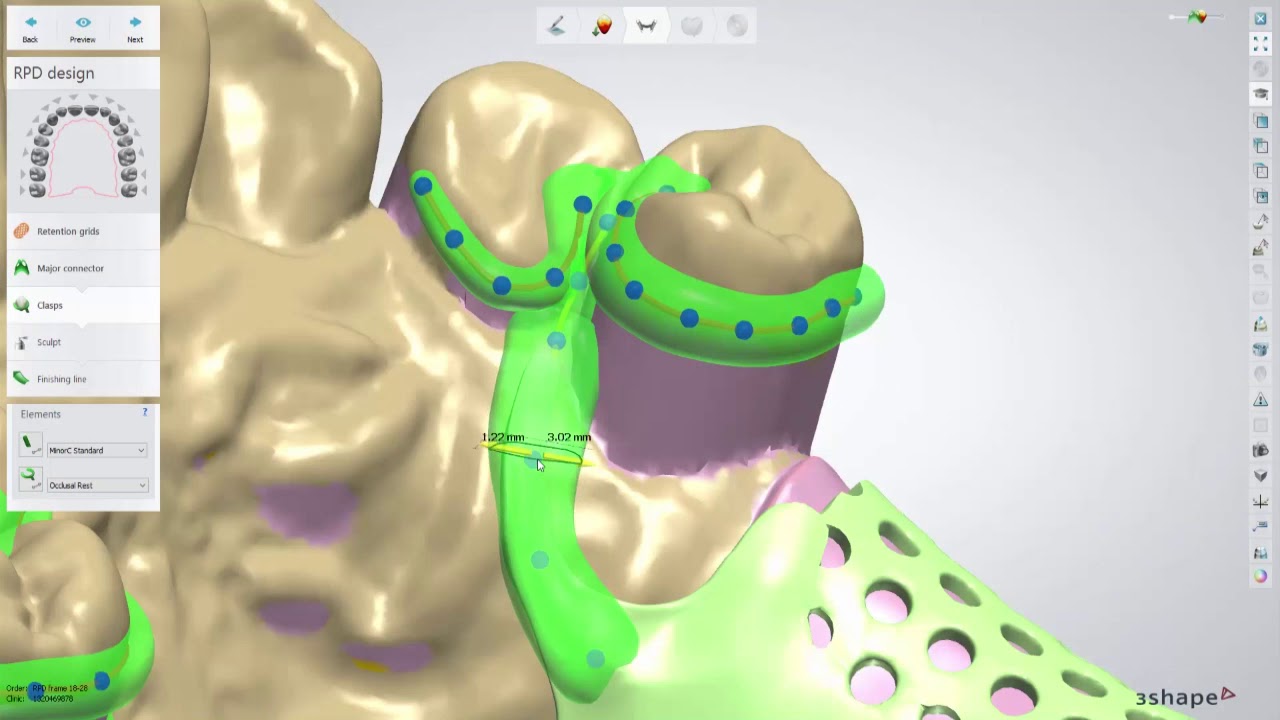 239 - Upper RPD Class I - YouTube