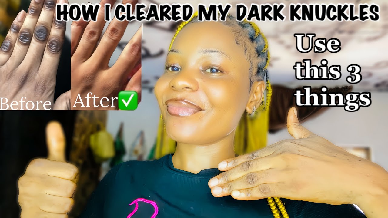 HOW TO CLEAR DARK KNUCKLES VERY FAST - YouTube