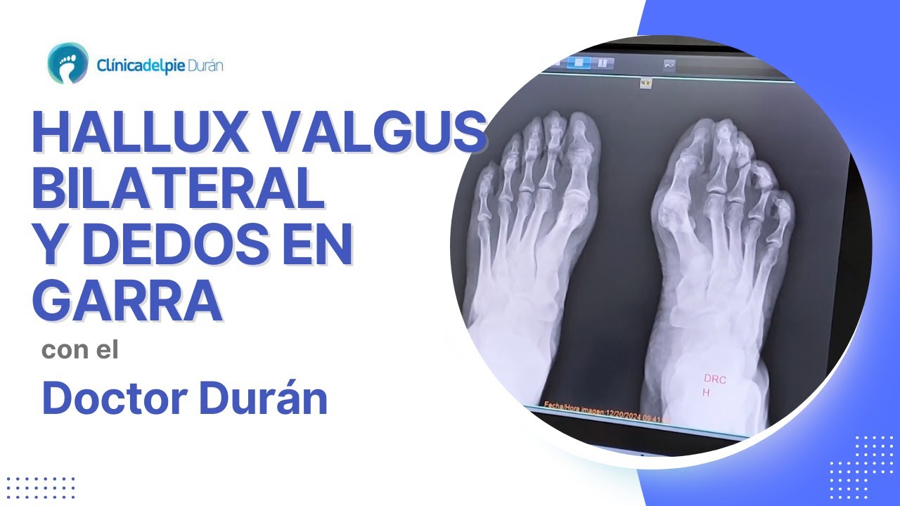 El hallux valgus y los dedos en garra con el Doctor Durán | CLÍNICA DEL ...
