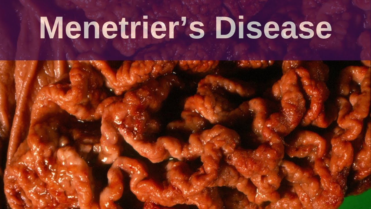 Menetrier's Disease - Pathology mini tutorials - YouTube