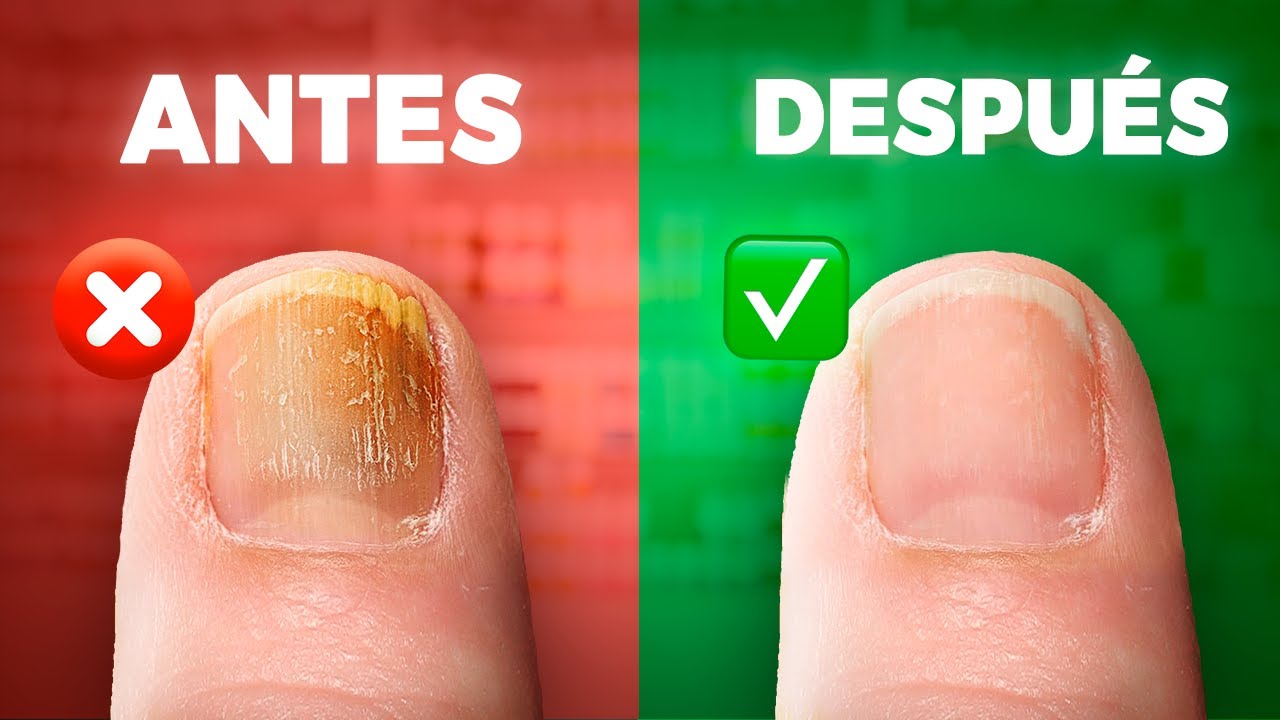 ¿Hongos en las UÑAS? ONICOMICOSIS | Diagnóstico y Tratamiento correcto ...