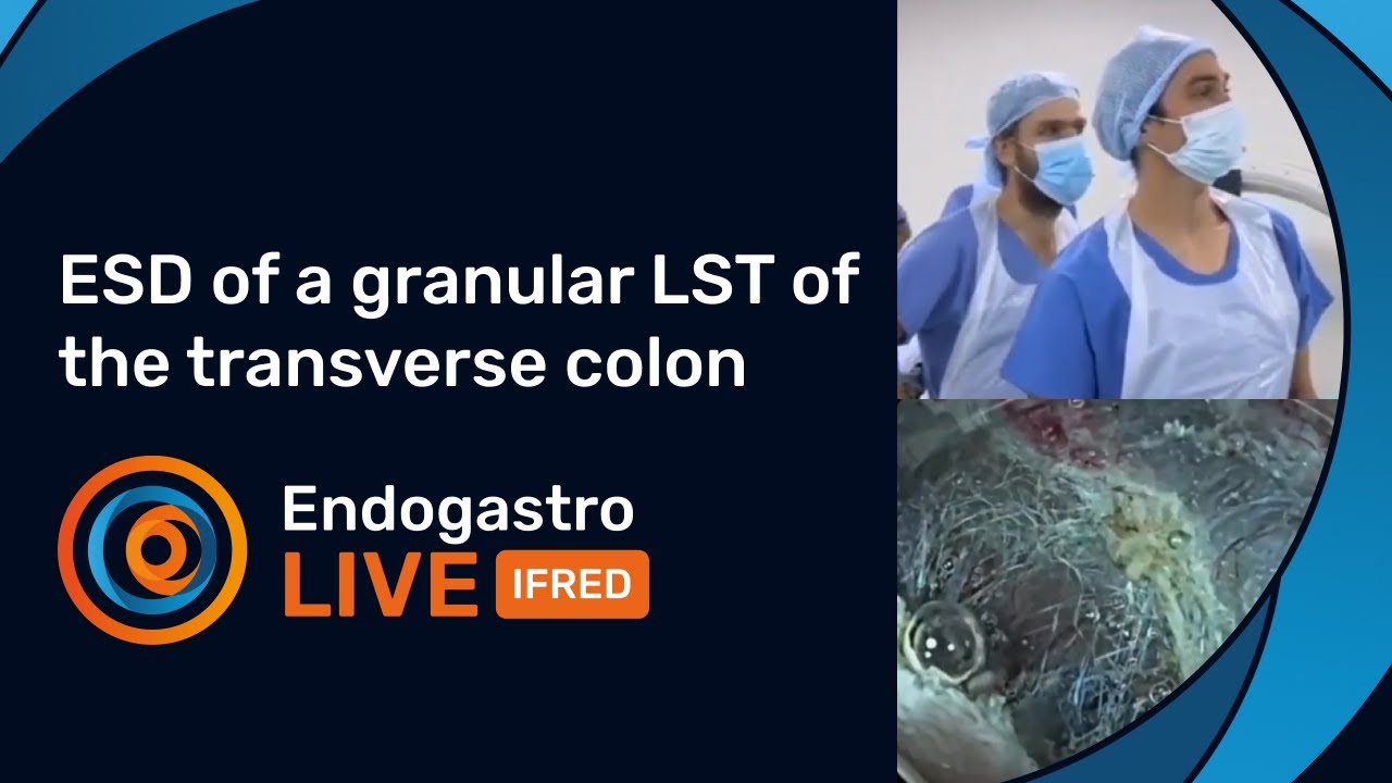 ESD of a granular LST of the transverse colon - YouTube