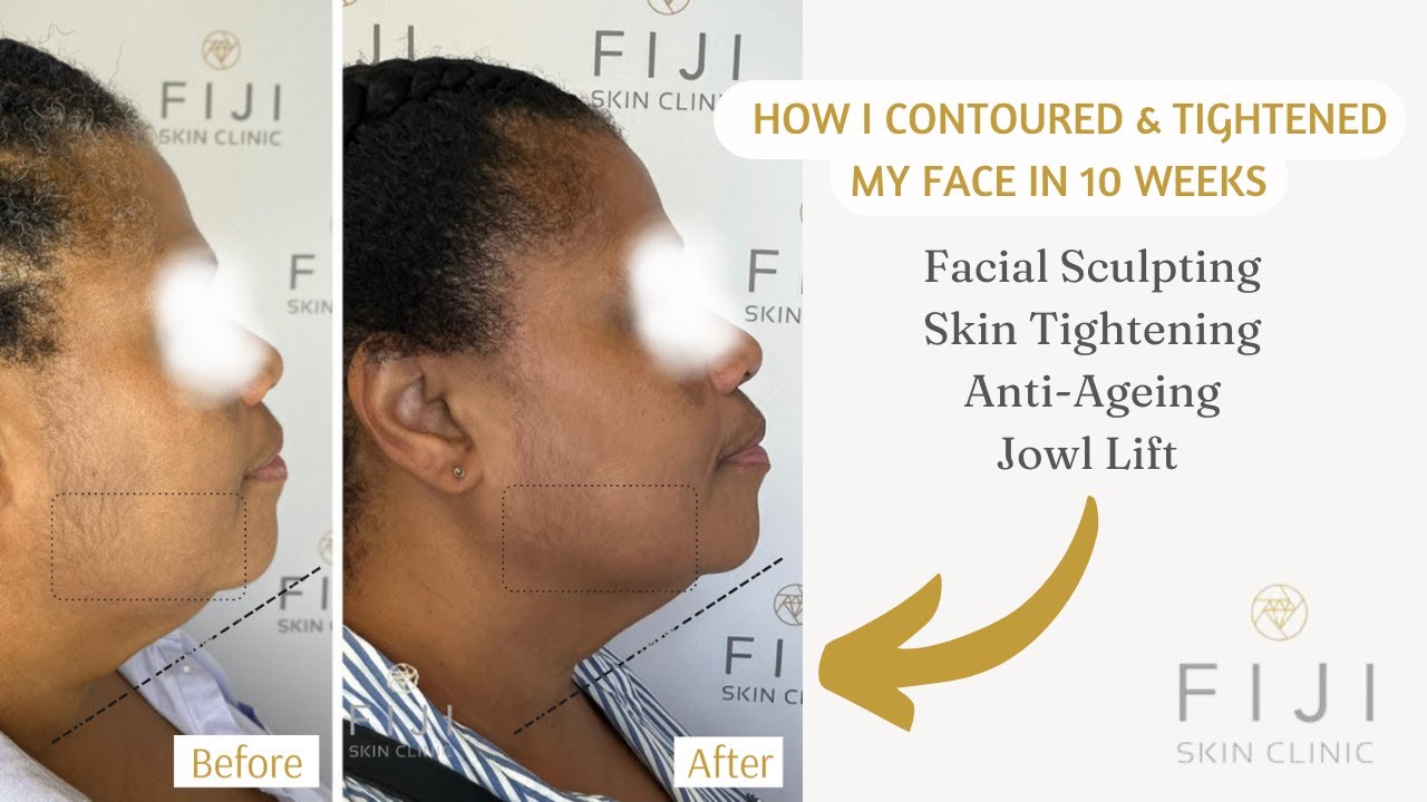 How I Contoured & Tightened My Face in 10 Weeks | Non-Surgical Jowl ...