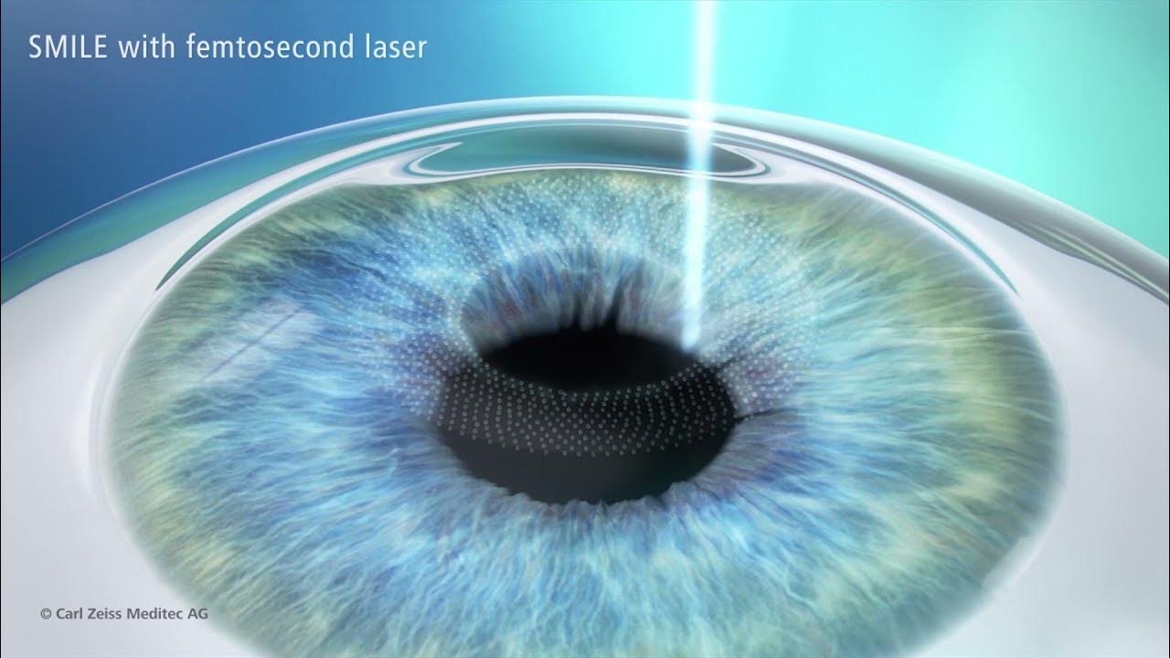 Treatment with SMILE Animation - YouTube