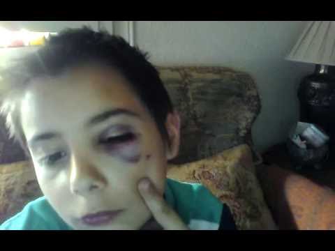 derrame facial - YouTube