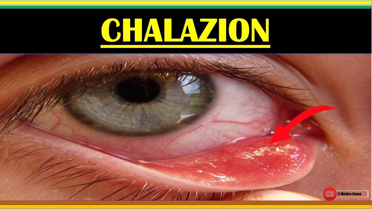 Chalazion | Causes | Sign & Symptoms | Diagnosis | Treatment - YouTube