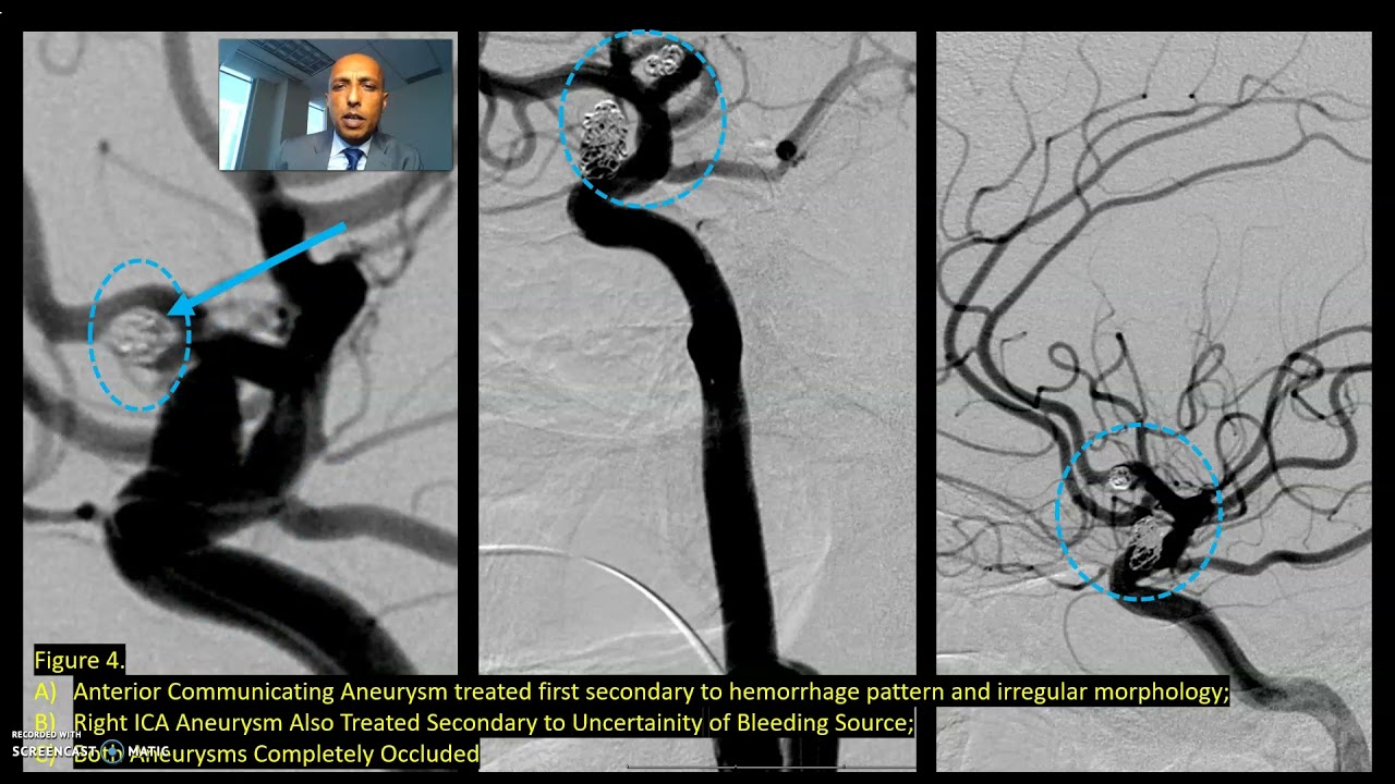 NSPC Brain & Spine Surgery's Dr. Sundeep Mangla: Treatment of Brain ...