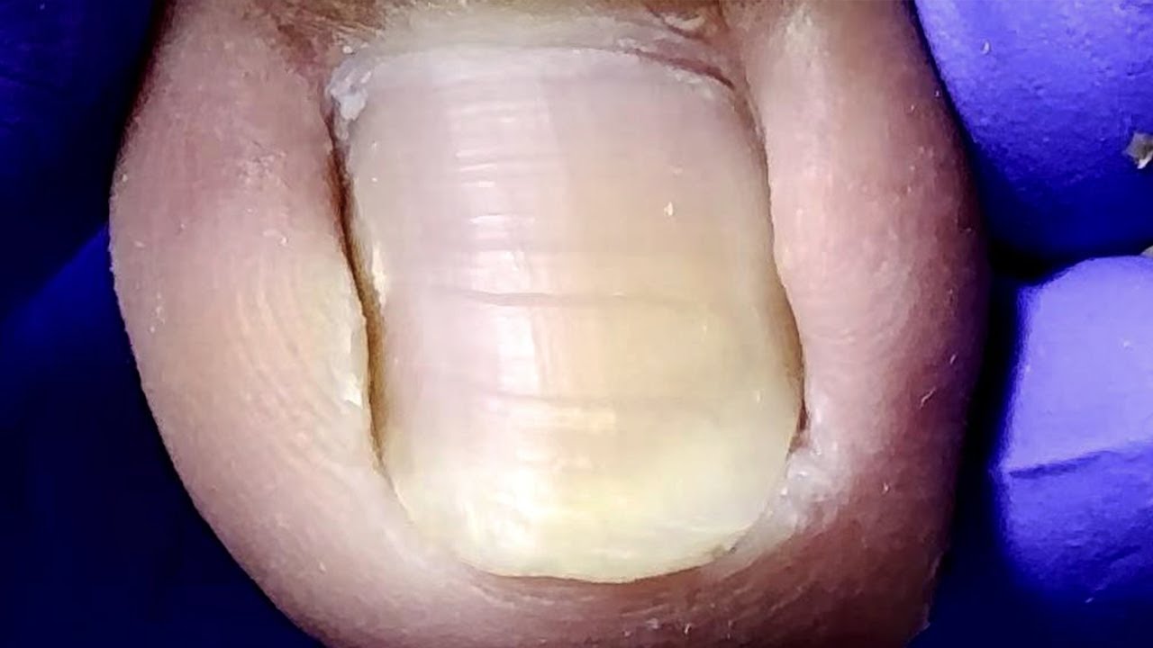 The middle of the nail is embedded, very rare, how to trim it without ...